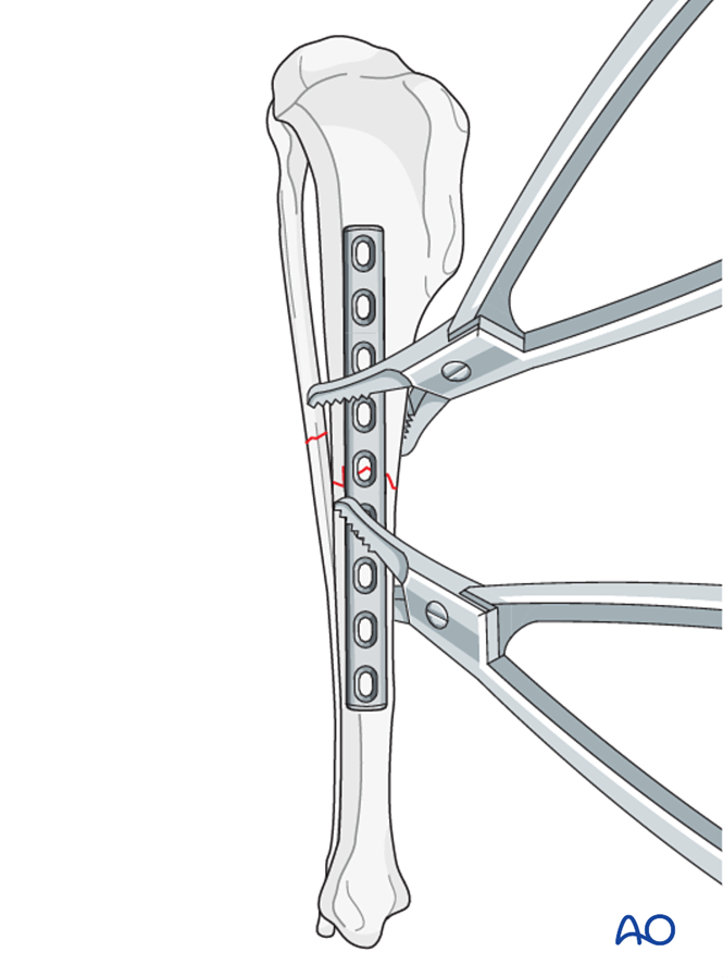 Compression plate for Simple transverse tibial
