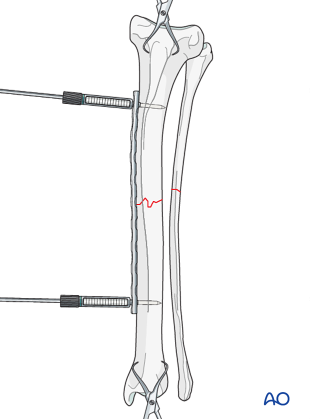 Compression plate for Simple transverse tibial
