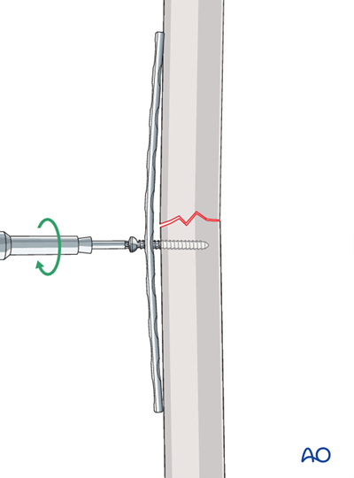 Compression plate for Simple transverse tibial