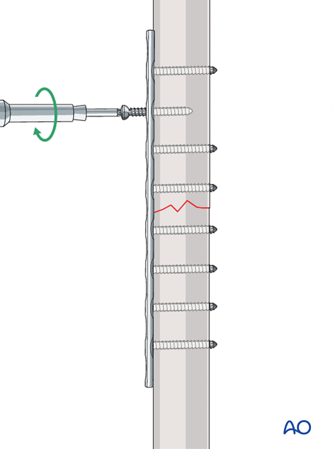 Compression plate for Simple transverse tibial