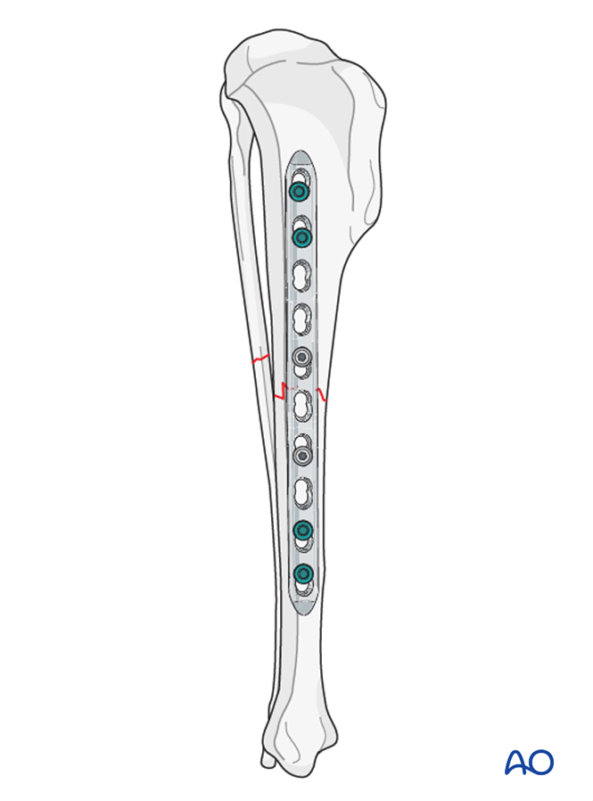 Compression plate for Simple transverse tibial