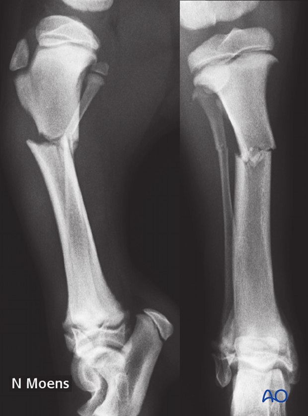 Simple transverse tibial fracture