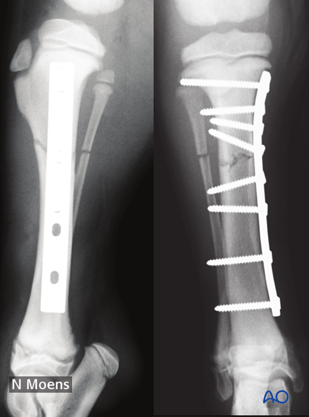 Compression plate for Simple transverse tibial