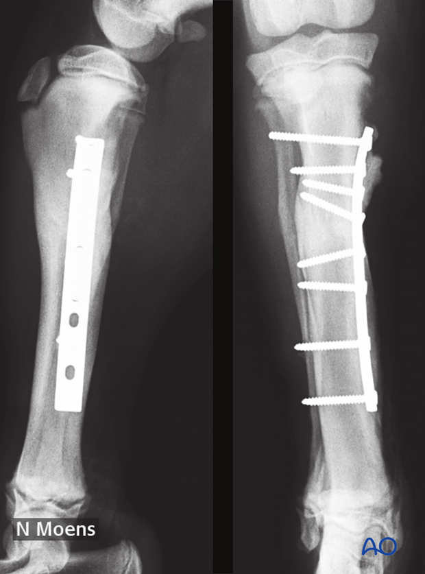 Compression plate for Simple transverse tibial