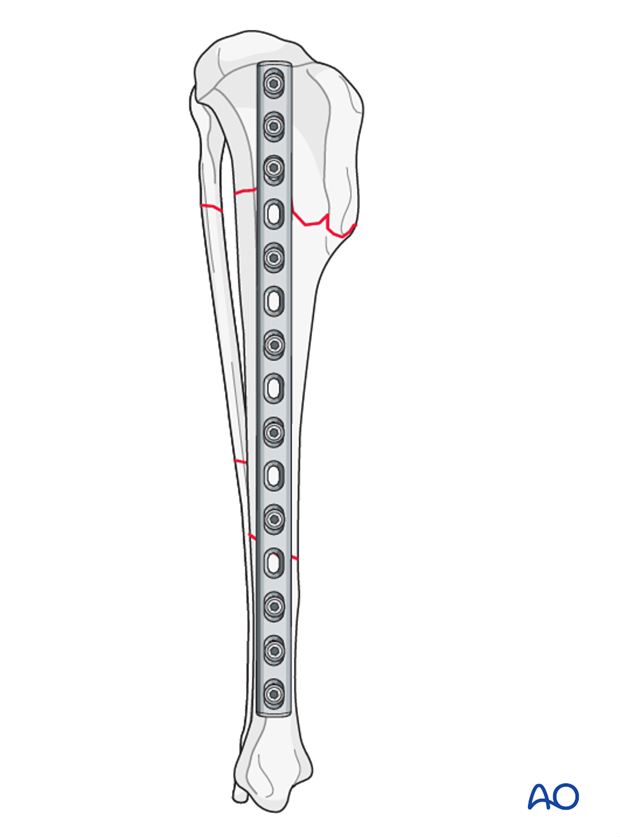 Compression plate for Complex segmental