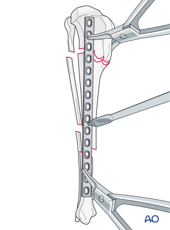 Compression plate for Complex segmental