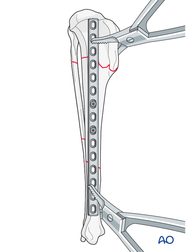 Compression plate for Complex segmental