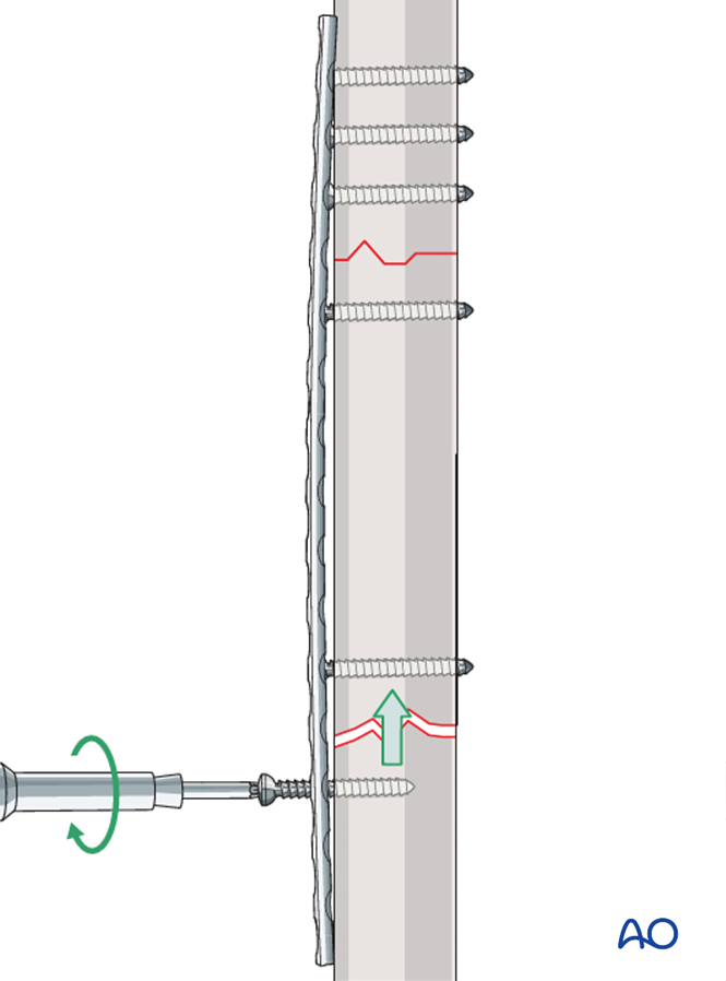 Compression plate for Complex segmental