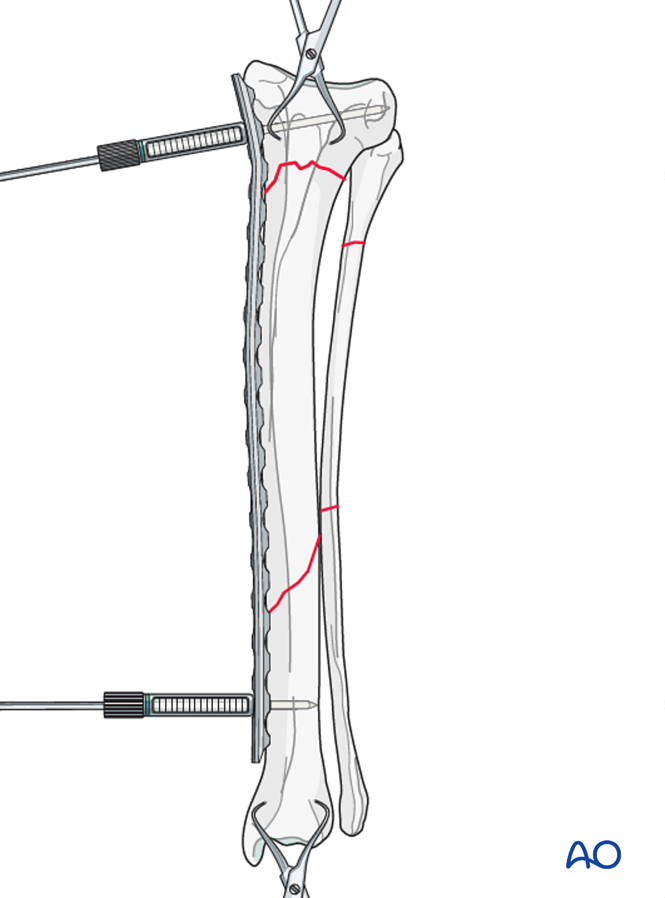 Compression plate for Complex segmental