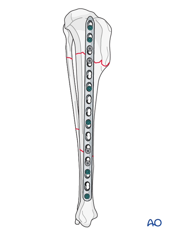 Compression plate for Complex segmental