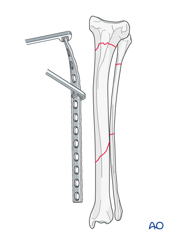 Compression plate for Complex segmental