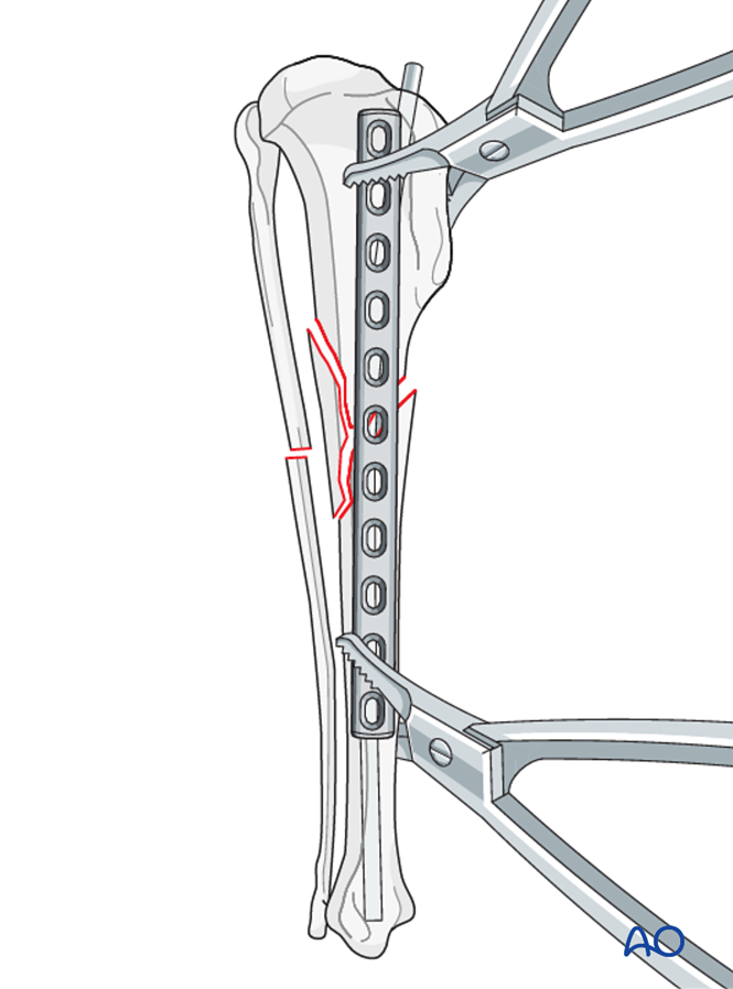 Plate and rod for One large reducible wedge in the tibial diaphysis