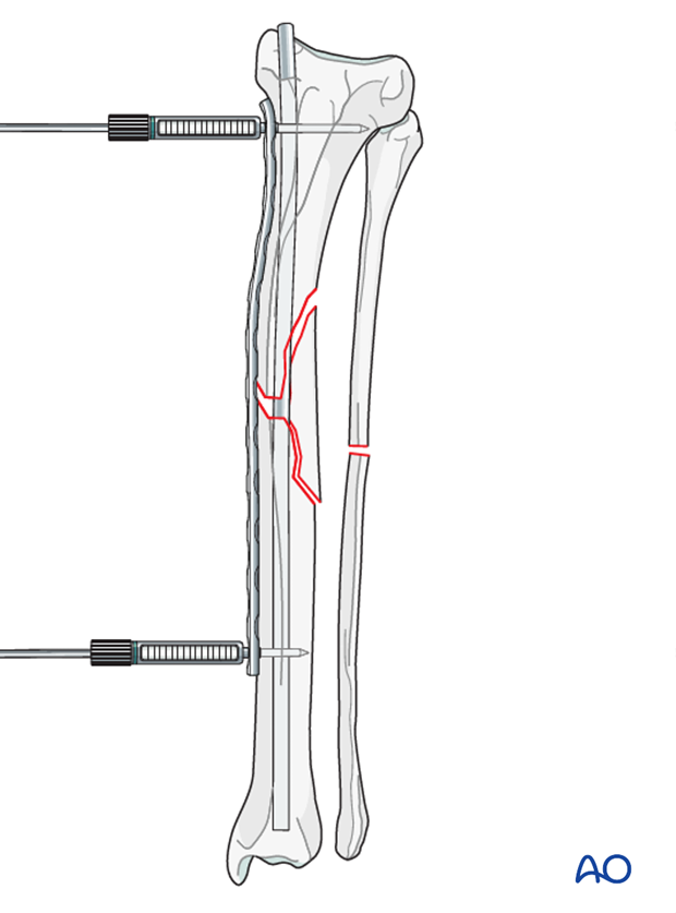 Plate and rod for One large reducible wedge in the tibial diaphysis