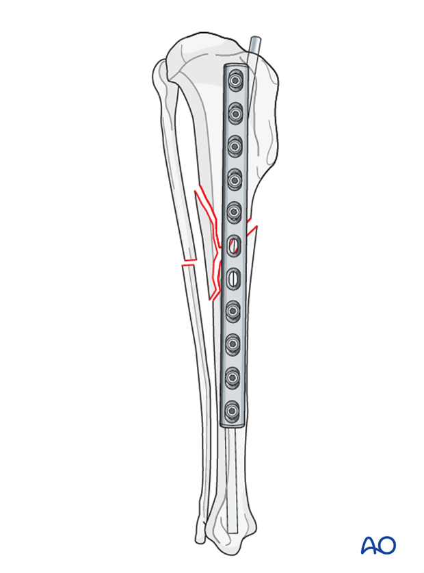 Plate and rod for One large reducible wedge in the tibial diaphysis
