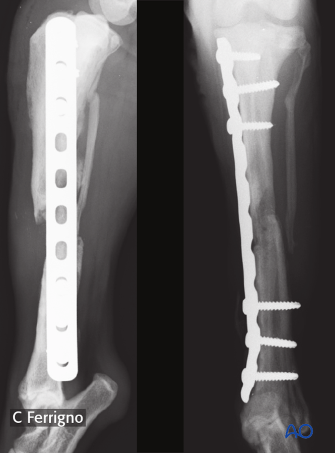Plate and rod for One large reducible wedge in the tibial diaphysis