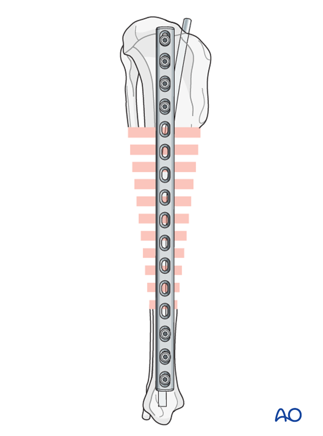 Plate and rod for Nonreducible wedges in the tibial diaphysis