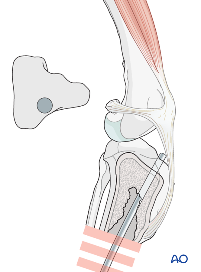 Plate and rod for Several reducible wedges in the tibial diaphysis