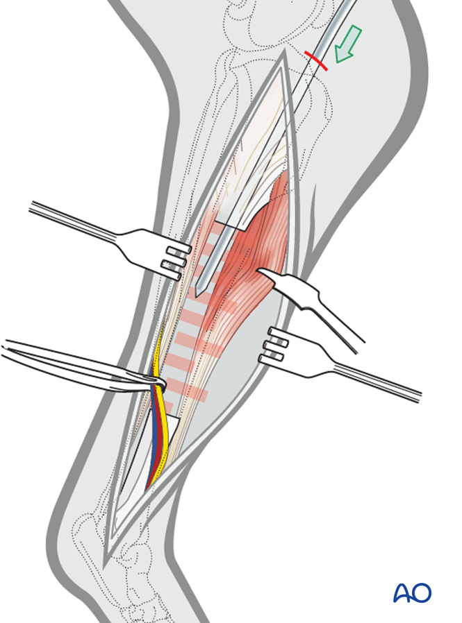 Plate and rod for Several reducible wedges in the tibial diaphysis