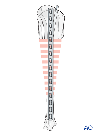 Plate and rod for Complex with nonreducible wedges in the tibial diaphysis