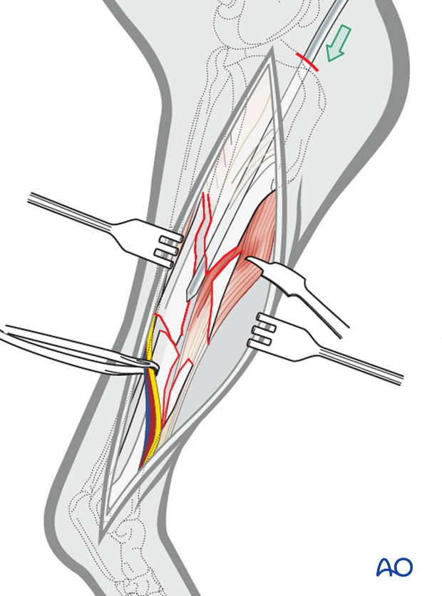 Plate and rod for Complex with reducible wedges in the tibial diaphysis
