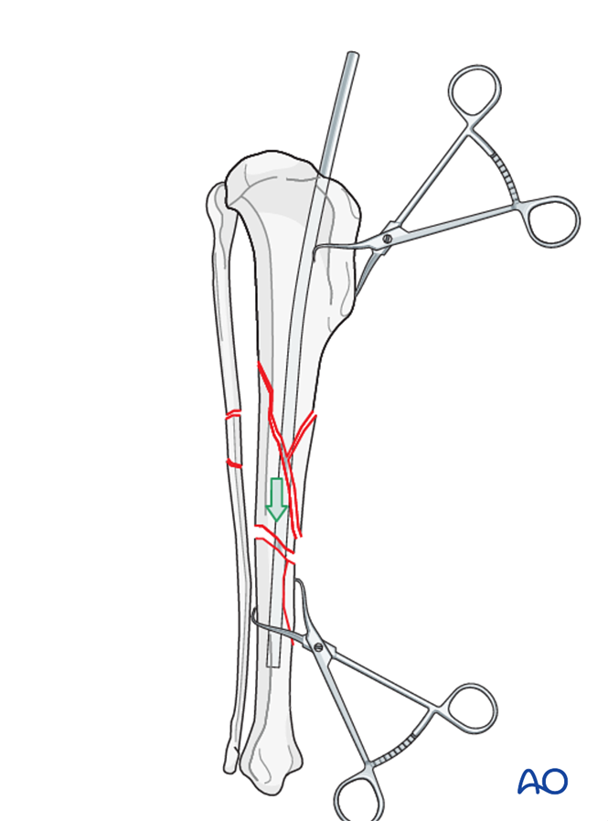 Plate and rod for Complex with reducible wedges in the tibial diaphysis