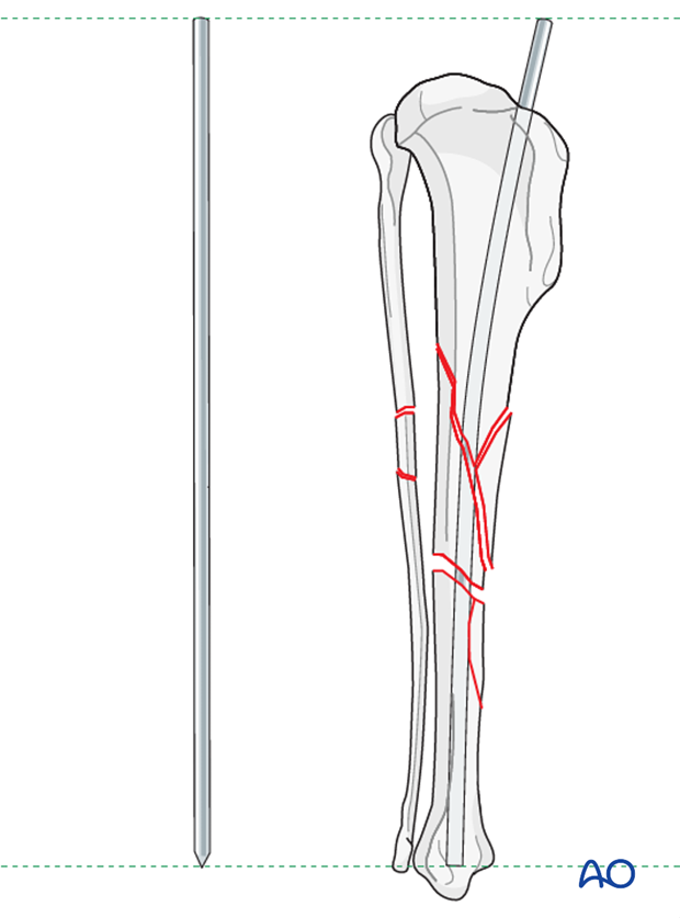 Plate and rod for Complex with reducible wedges in the tibial diaphysis