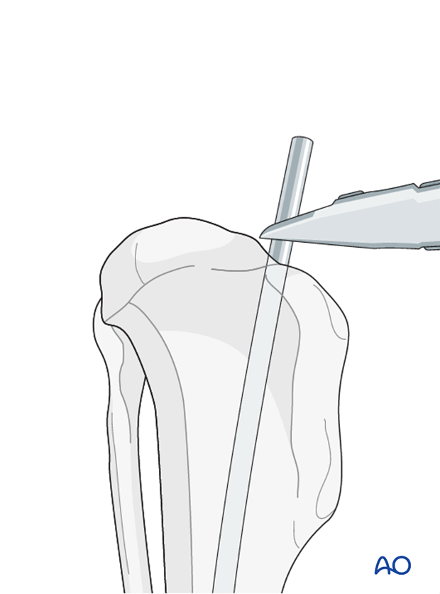 Plate and rod for Complex with reducible wedges in the tibial diaphysis