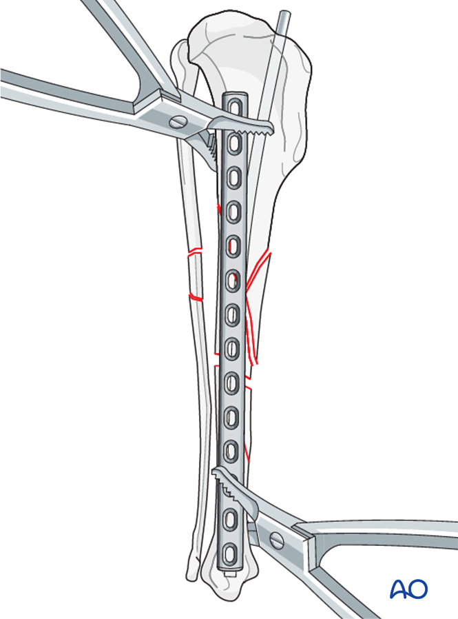 Plate and rod for Complex with reducible wedges in the tibial diaphysis