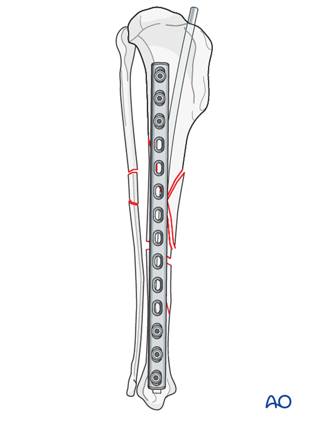 Plate and rod for Complex with reducible wedges in the tibial diaphysis