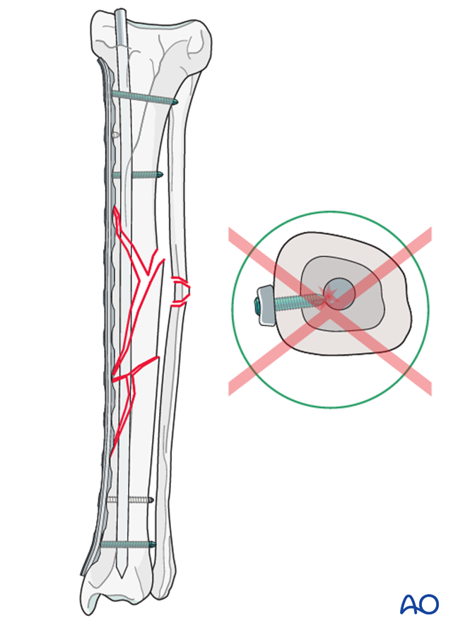 Plate and rod for Complex with reducible wedges in the tibial diaphysis