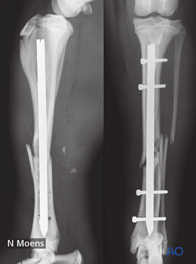 Interlocking nail for Nonreducible wedges in the tibial diaphysis