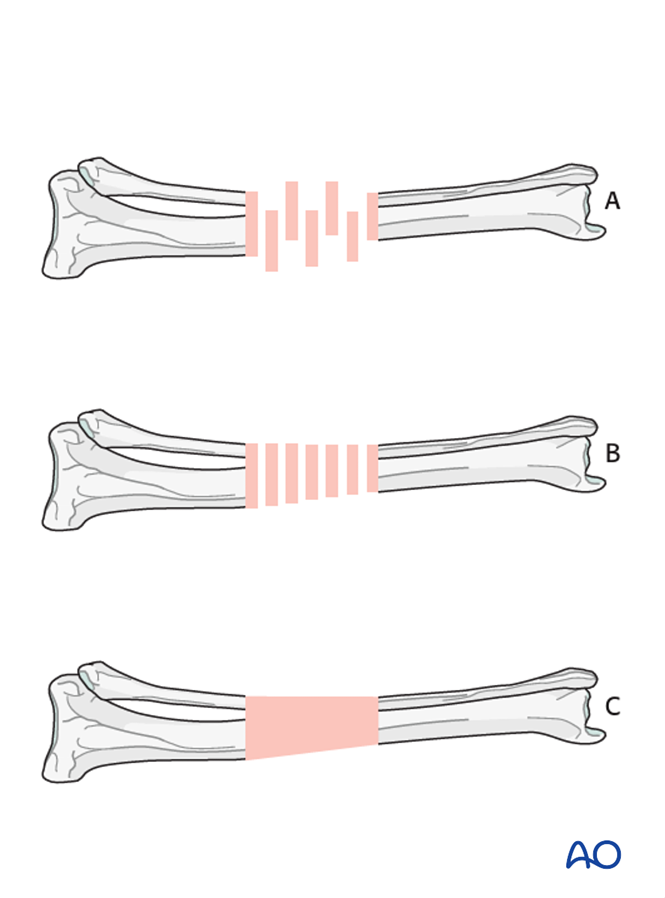 Plate and rod for Nonreducible wedges in the tibial diaphysis