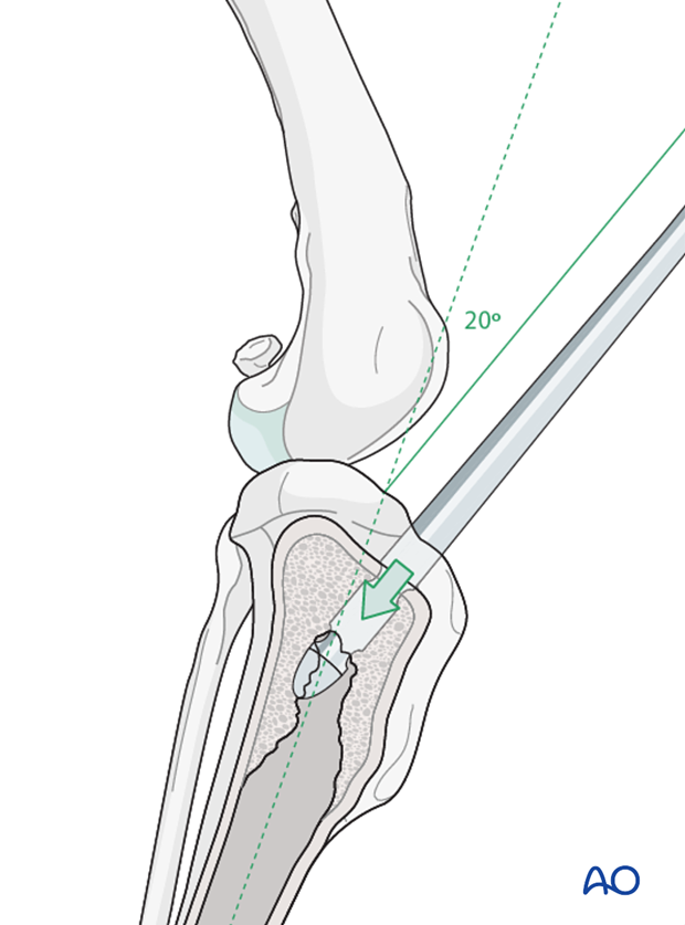 Interlocking nail for Nonreducible wedges in the tibial diaphysis