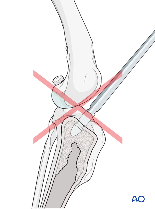 Interlocking nail for Complex with nonreducible wedges in the tibial ...