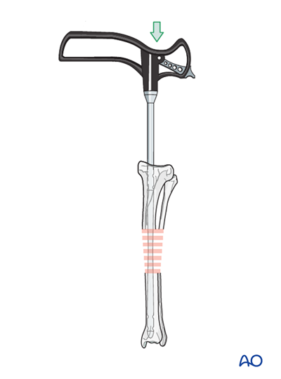 Interlocking nail for Complex with nonreducible wedges in the tibial ...