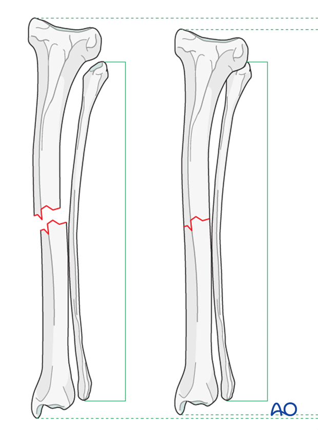 Bridging plate for Incomplete fracture of the tibia or complete ...