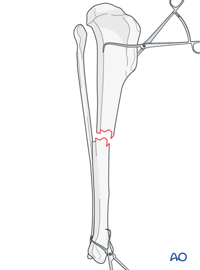 Bridging plate for Incomplete fracture of the tibia or complete ...