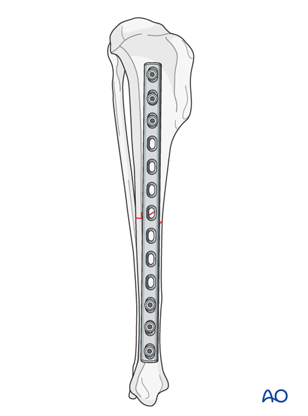 Bridging plate for Incomplete fracture of the tibia or complete ...