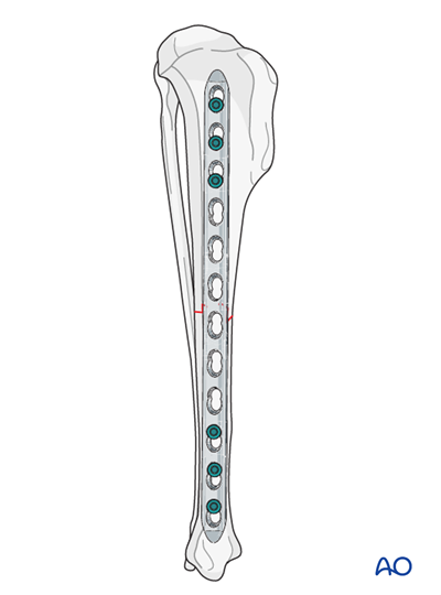 Bridging plate for Incomplete fracture of the tibia or complete ...