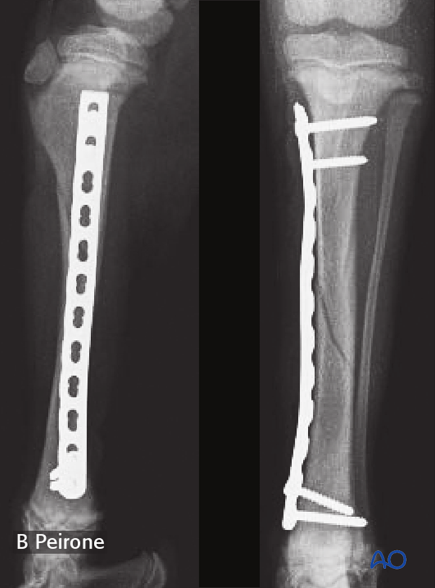 Bridging plate for Incomplete fracture of the tibia or complete ...