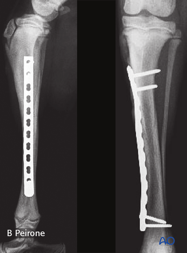 Bridging plate for Incomplete fracture of the tibia or complete ...