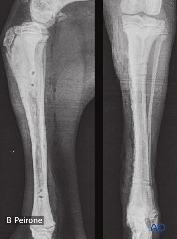 Bridging plate for Incomplete fracture of the tibia or complete ...