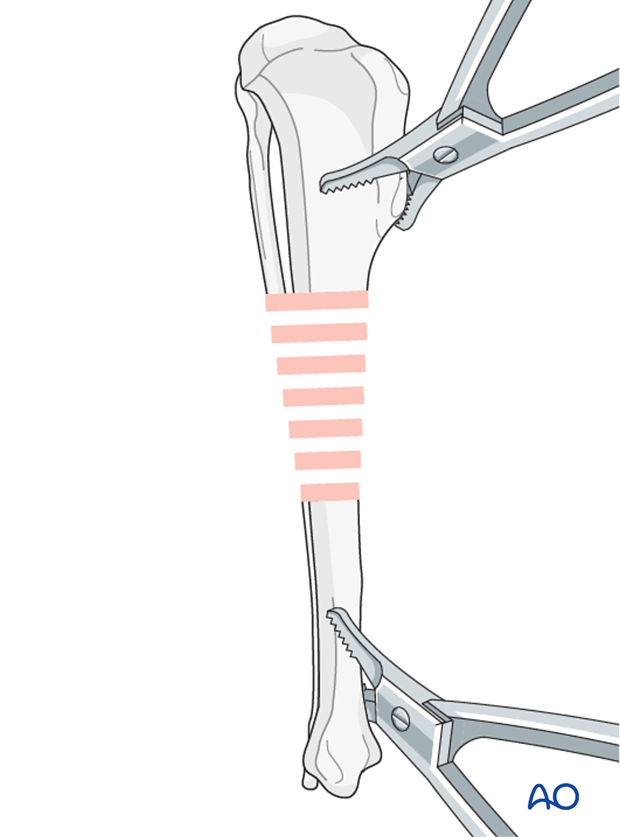 Bridging plate for Complex with nonreducible wedges in the tibial diaphysis