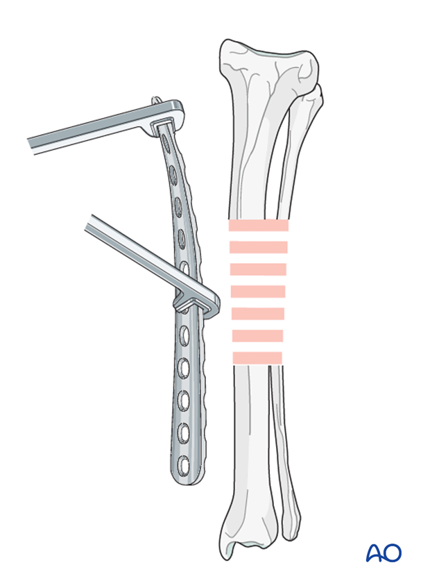 Bridging plate for Nonreducible wedges in the tibial diaphysis