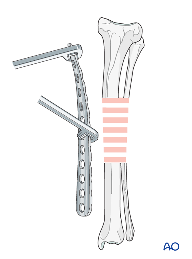 Bridging plate for Nonreducible wedges in the tibial diaphysis