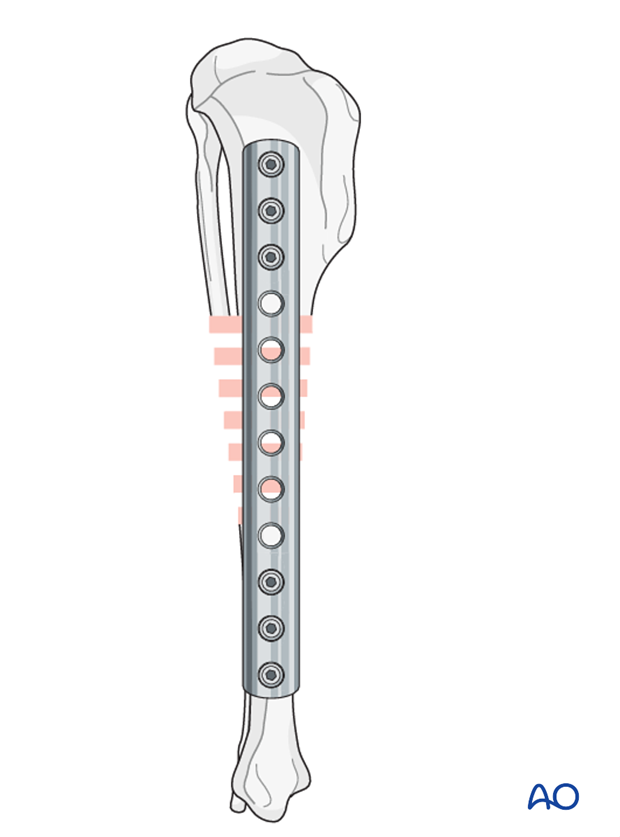 Bridging plate for Complex with nonreducible wedges in the tibial diaphysis