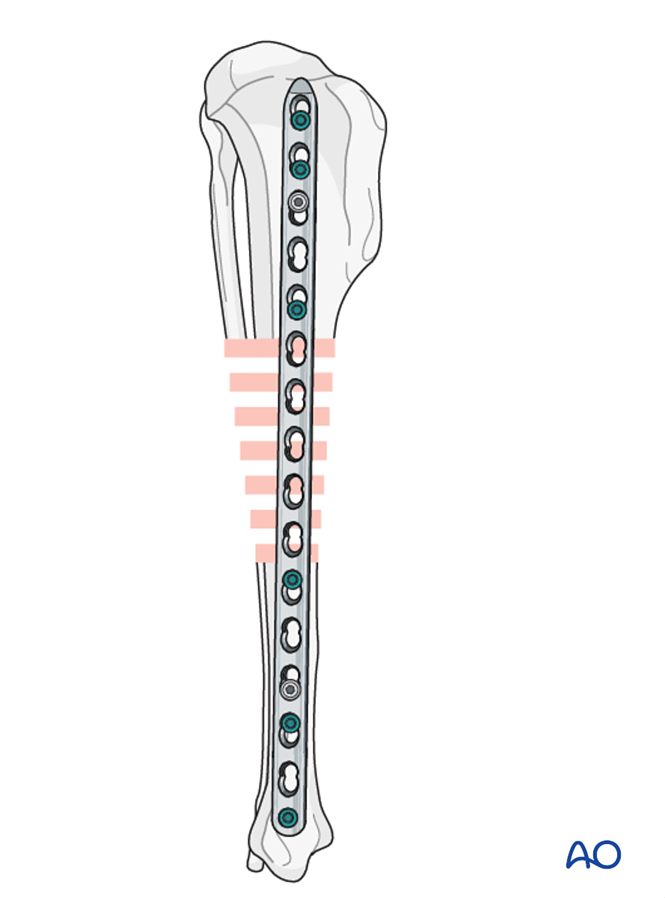 Bridging plate for Several reducible wedges in the tibial diaphysis