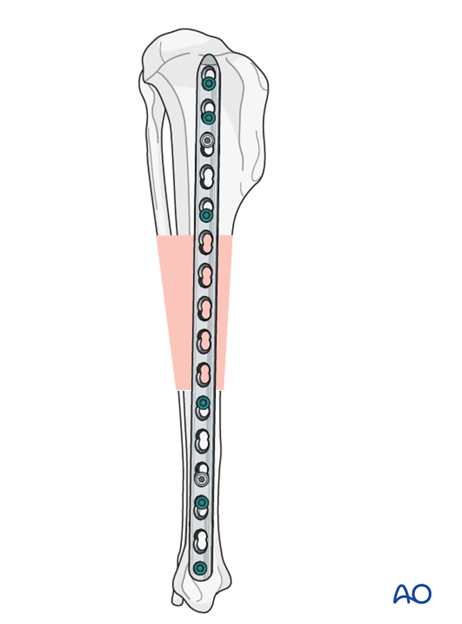 Bridging plate for Nonreducible wedges in the tibial diaphysis