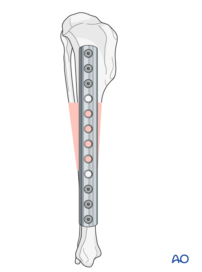 Bridging plate for Complex with nonreducible wedges in the tibial diaphysis