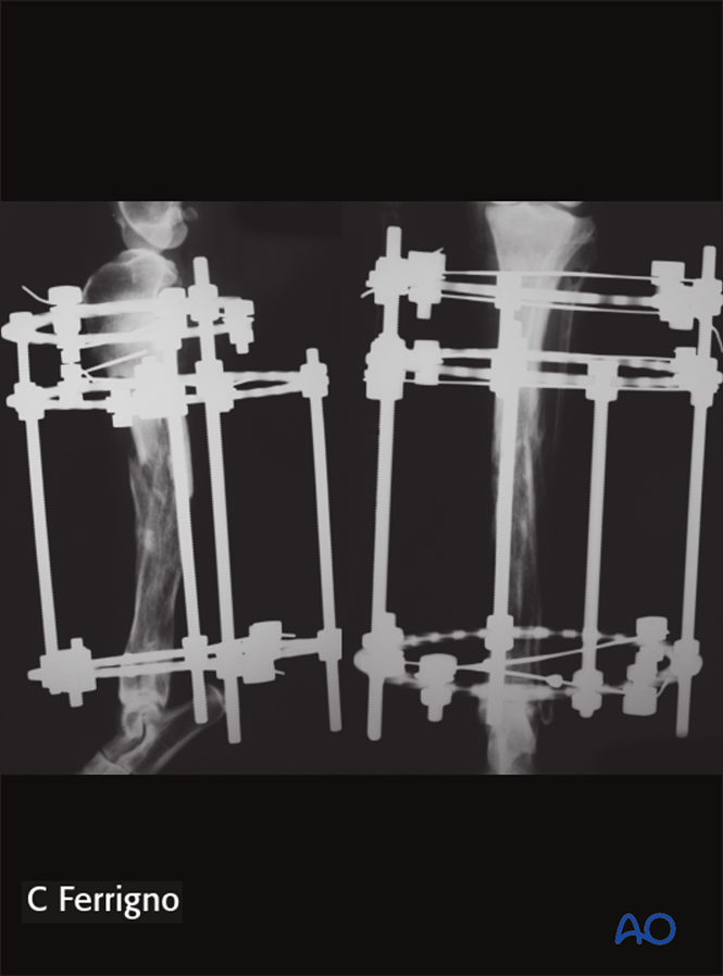 External fixator for Complex with nonreducible wedges in the tibial ...